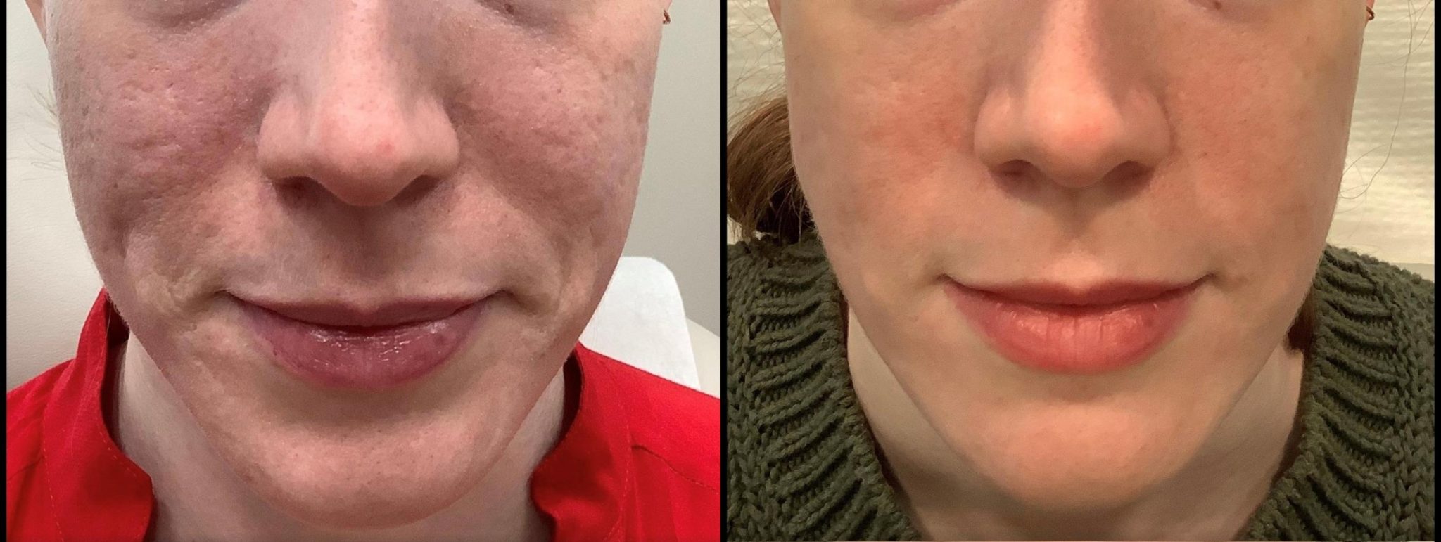 Skin Tightening: Microneedling & RF Microneedling Before and After – MI ...