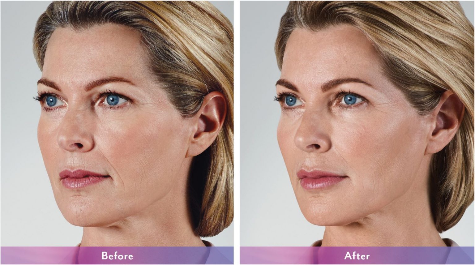 JUVÉDERM VOLLURE™ XC for Wrinkle Injections in Washington, DC | MI Skin